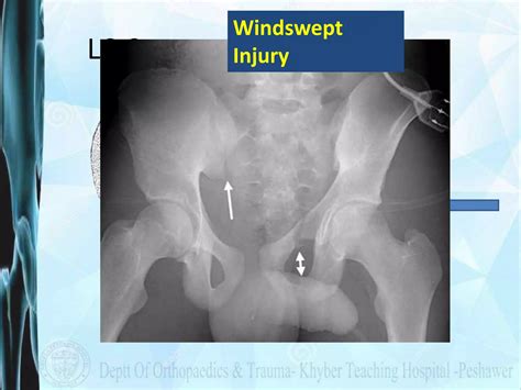 Pelvic Fracture Classification Pptx