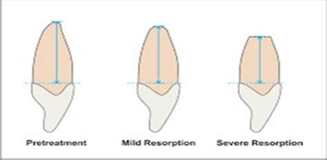 Figure 1 From Is Apical Root Resorption Greater When Using Clear Aligners As Compared To