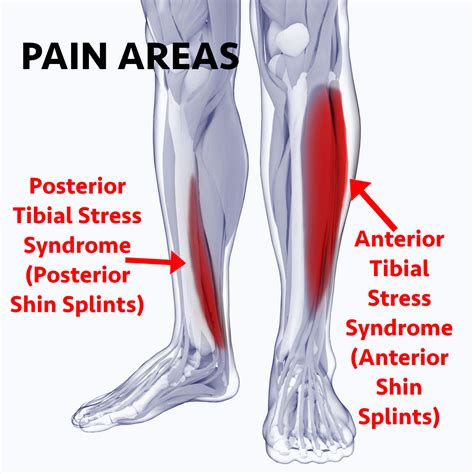 Shin Splints The Foot Force Podiatry