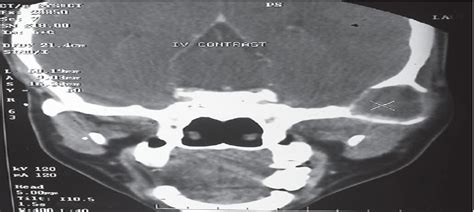 Giant Cell Reparative Granuloma Of Temporal Bone Indian Journal Of