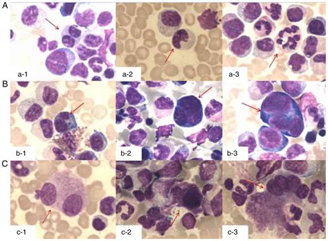 Acute Pro‑b‑cell Lymphoblastic Leukemia Transformed From