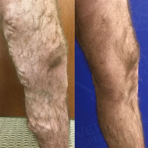 Before And After Vein Treatment Photos Vein Specialists Of The Carolinas