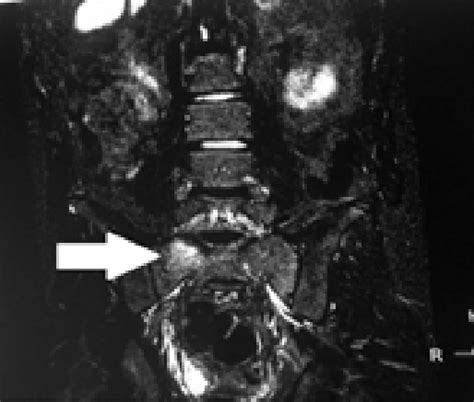 Stir Magnetic Resonance Image Show Subtle Hyperintensity In The Body Of Download Scientific