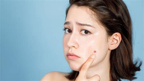 How To Reduce Redness From Pimples