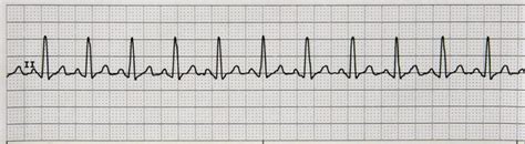 Figure 717 Sinus Tachycardia Nursing Advanced Skills Ncbi