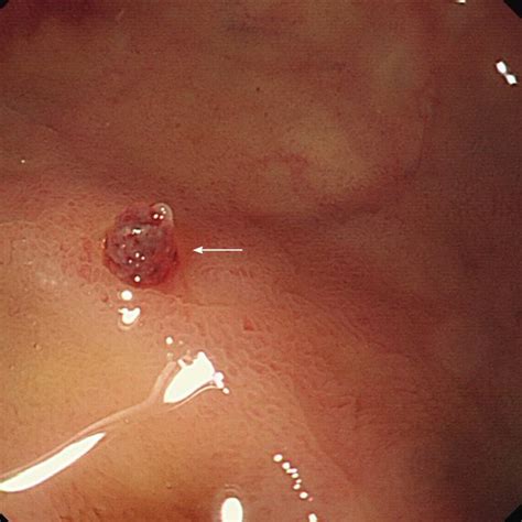 Endoscopic View Of The Diverticulum Located In The Descending Duodenum Download Scientific