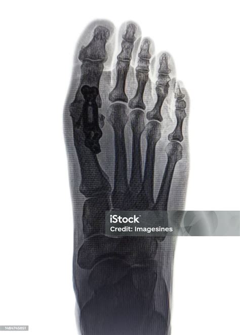 Xray Image Of Bone Block Distraction Arthrodesis Mtp1 Of The Hallux