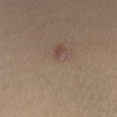 켈로이드 피부 지식in