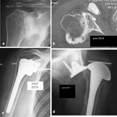 Mb Glenoid Implanted On A Type B2 A Dislocation Occured At 6 Months Download Scientific