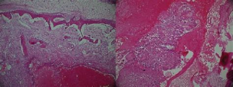 Hematoxylin And Eosin Stain Showing Giant Multinuclear Cells Stroma