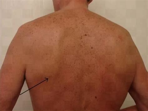 Elastofibroma Introduction