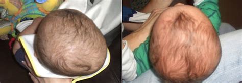 Infant Flat Head Treatment Plagiocephaly Helmet Therapy Cranial Uk