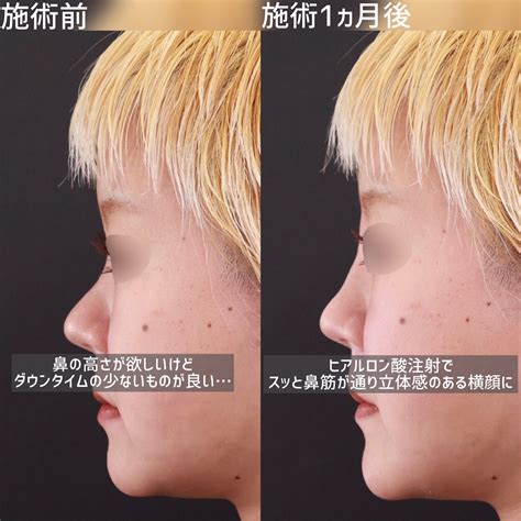 綺麗な鼻筋の横顔美人は施術直後からつくられる！【ヒアルロン酸注射】｜症例写真・ビフォーアフター｜美容整形･美容外科のtaクリニックグループ