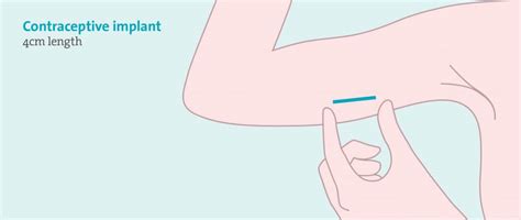 Long Acting Reversible Contraception Larcs Phocus On Lifestyle
