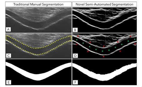 Description Of Manual And Semi Automated Femoral Cartilage Segmentation