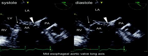 Cabrol Composite Graft For Aortic Root Replacement Echocard Anesthesia And Analgesia