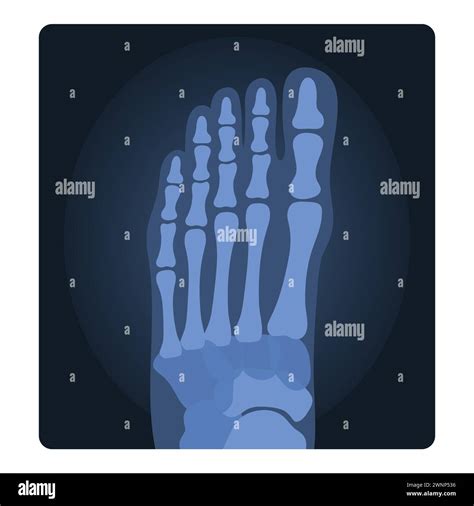 Xray Shot Of Human Foot Medical Skeleton Test Body Radiography