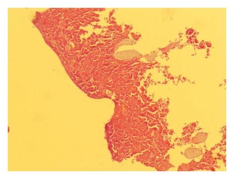 Pathology Evaluation Of Bone Marrow On D60 In Mice With Untreated A