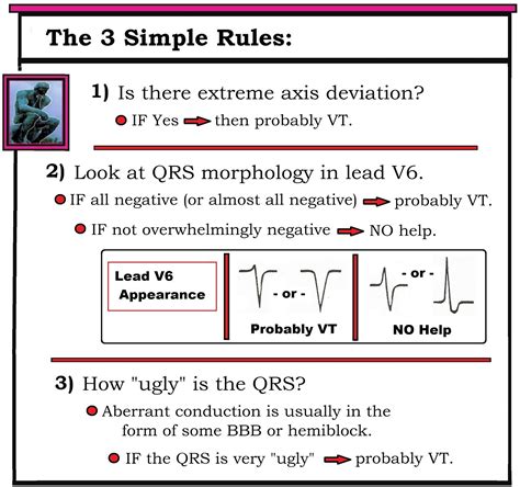 Ecg Interpretation Ecg Blog 42 What Criteria — Vt Vs Aberrancy