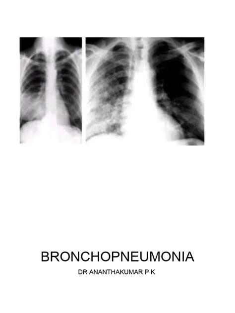 Bronchopneumonia Pdf