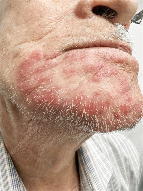 Ringworm Stock Image C060 1698 Science Photo Library