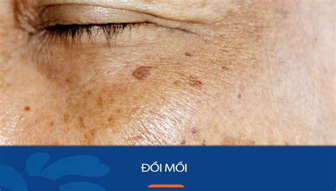 Đồi Mồi 6 Nguyên Nhân And 6 Cách điều Trị Hiệu Quả