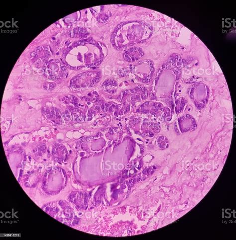 Follicular Adenoma Of Thyroid Gland Light Micrograph Histopathology Of Thydoid Adenoma Photo