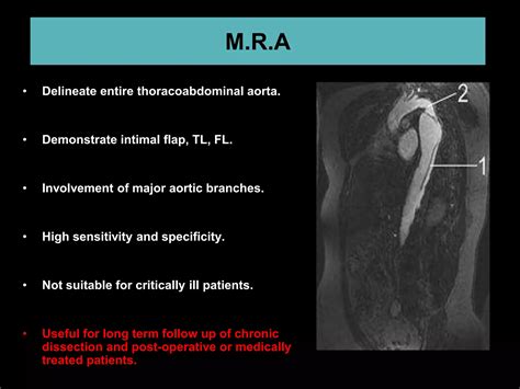 Type B AORTIC DISSECTION PPT