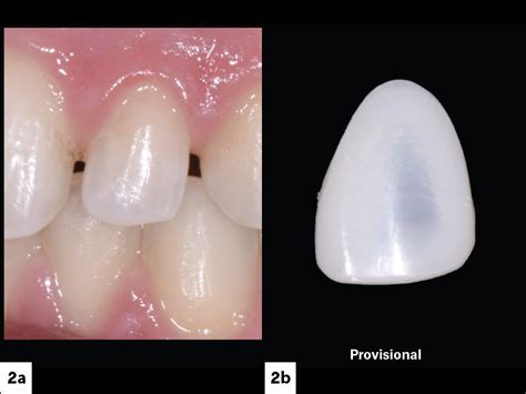 Veneer Preparation And Temporization Tips And Techniques