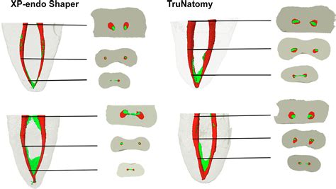 Disinfection And Shaping Of Vertucci Class Ii Root Canals After