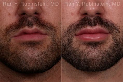 Lip Fillers In Newburgh Ny Hudson Valley Dr Rubinstein