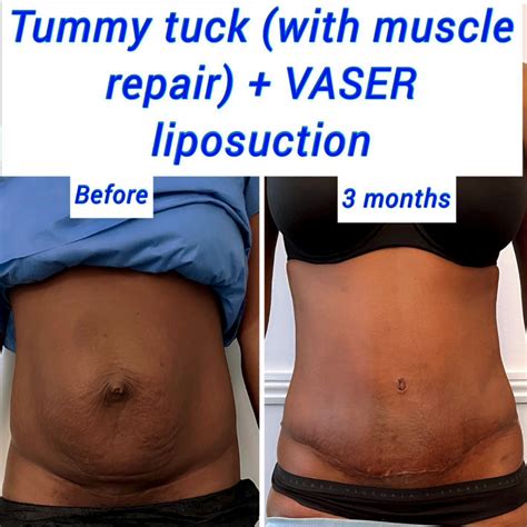 Tummy Tuck With Muscle Repair Before And After
