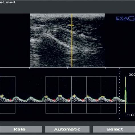 Assessment Of Blood Flow Indices Resistive And Pulsatility Index For Download Scientific