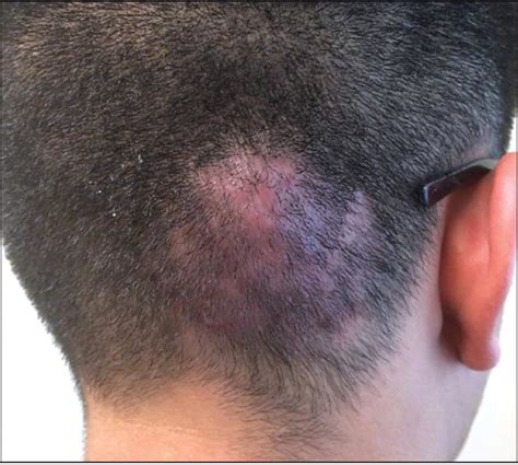 Swelling And Erythema Of The Scalp On A Teenager Aafp