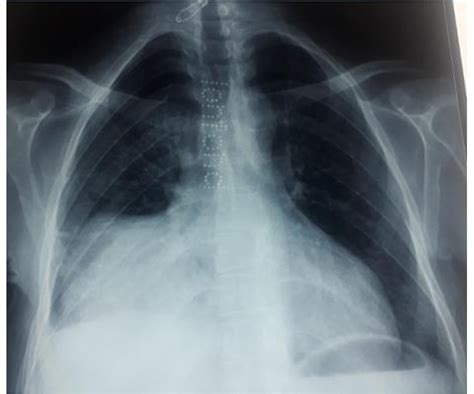 Homogenous Lesion In The Right Hemithorax Extending From The Hilum To Download Scientific