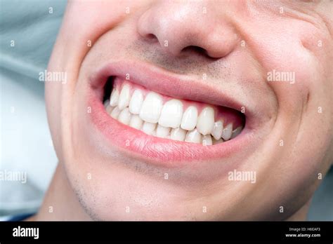 Perfect Bottom Teeth