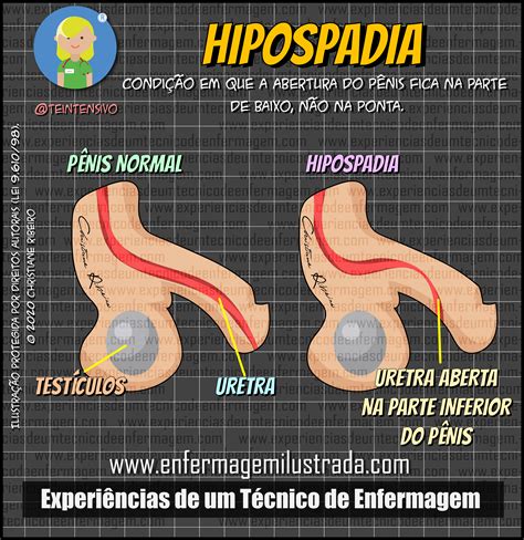 Hipospádia Enfermagem Ilustrada