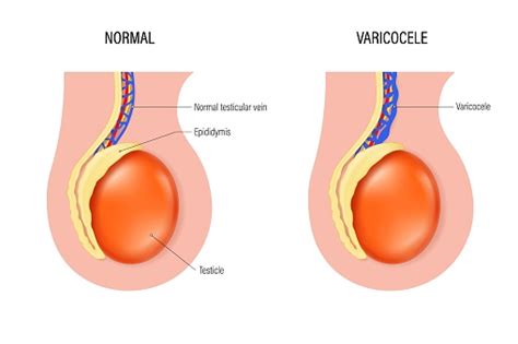 Varicocele Vector Comparison Of Normal Testicular Vein And Varicocele