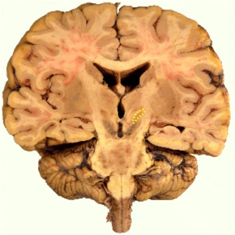 Neuro 2 Final Practical Flashcards Quizlet