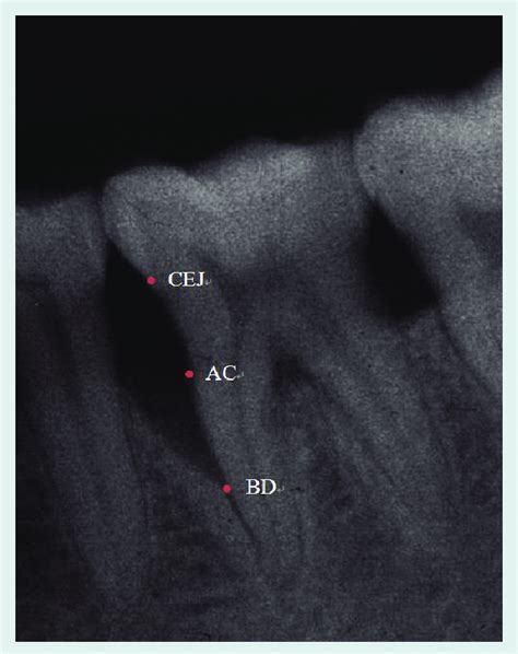 Radiographic Landmarks Ac Alveolar Crest Bd Base Of The Defect