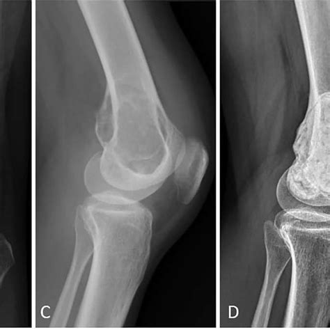 Pdf Clinical Outcomes Of Extended Intralesional Curettage With