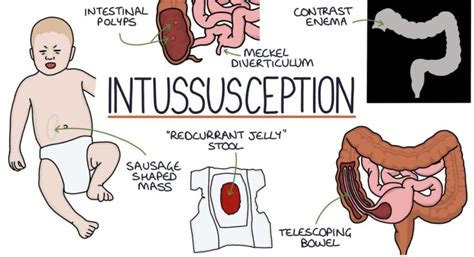 Intussusception Diagnosis And Treatment