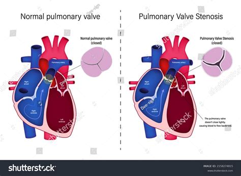 Difference Normal Pulmonary Valve Pulmonary Valve Stock Vector Royalty Free 2158274815