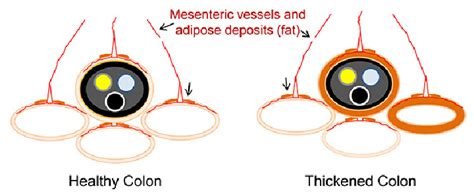Cross Sectional Representation Of Intestinal Loops To Illustrate The Download Scientific