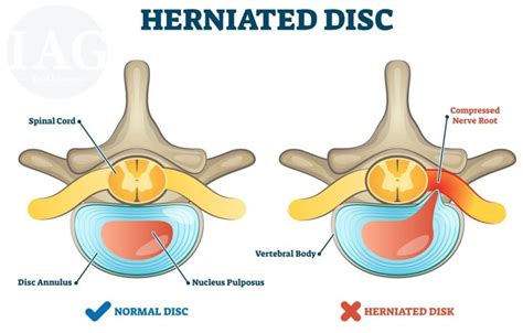 Herniated Disc Settlement With Surgery At Loren Beckner Blog