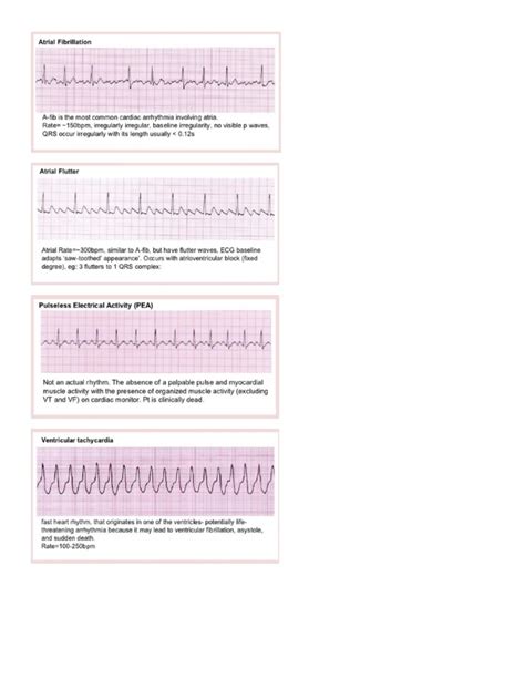 10000印刷√ Ekg Vt Dan Vf 233083 Ekg Vt Dan Vf 10000印刷√ Ekg Vt Dan Vf 233083 Ekg Vt Dan Vf