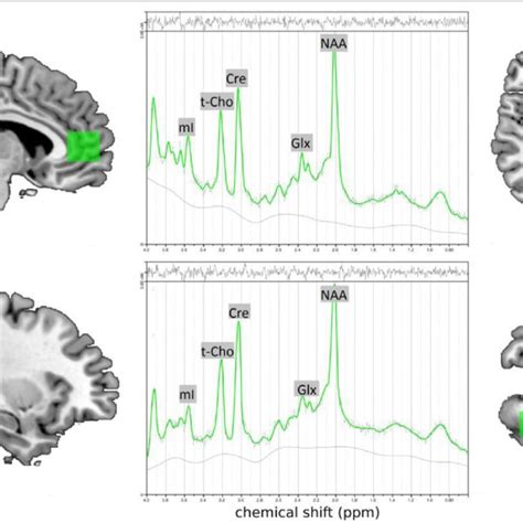 Voxel Localization In The Pregenual Anterior Cingulate Cortex Upper
