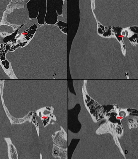 Carotid Cochlear Dehiscence A Dangerous Mimicker Of Inner Ear
