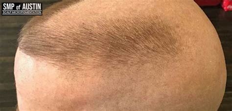 Scalp Micropigmentation Can Cover Hair Transplant Scars Smp Of Austin Scalp Micropigmentation Can Cover Hair Transplant Scars Smp Of Austin