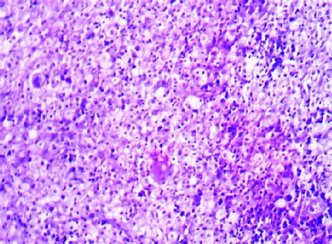 Xanthogranulomatous Pyelonephritis Histology